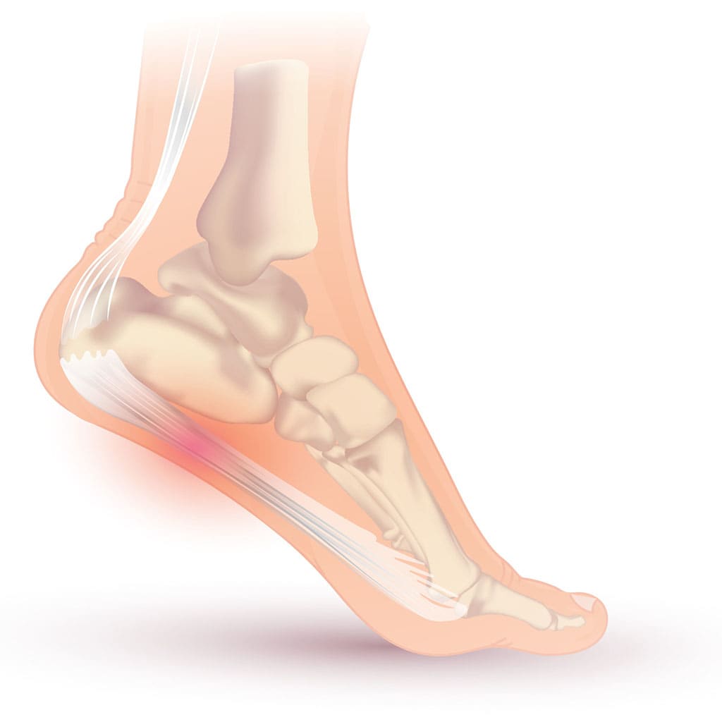 Plantaire Fasciitis | atelier-yuwa.ciao.jp