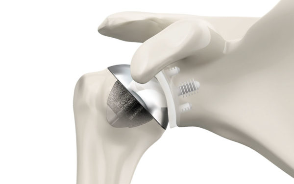 Prothèse d'épaule - Dr Philippe LORIAUT | Orthopédiste
